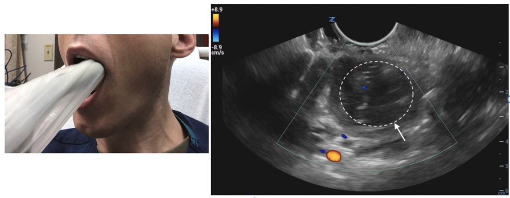 Intraoral POCUS in the Management of Peritonsillar Abscess – Sinai EM